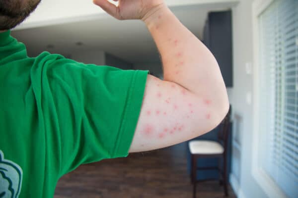 Bettwanzen Bisse erkennen und behandeln: Wie sie aussehen und was hilft ...