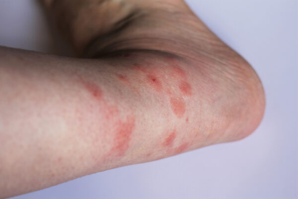 Grasmilben erkennen, Bisse behandeln und Hausmittel - ERASIO