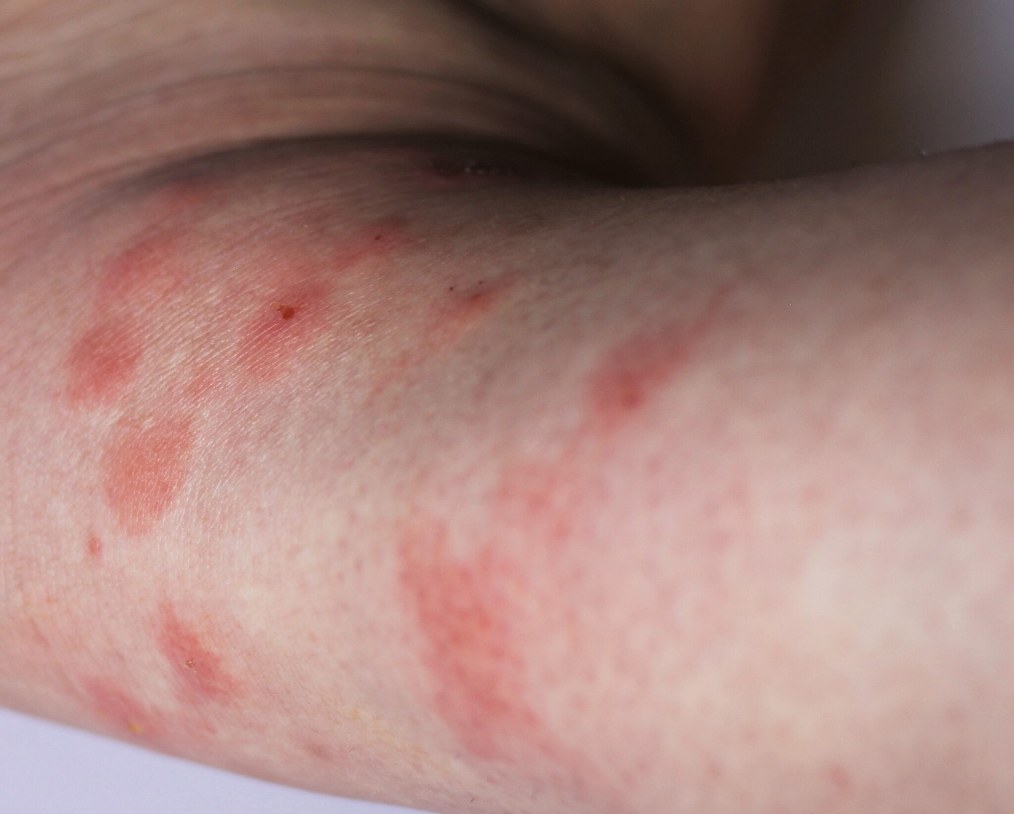 Flohbisse erkennen und behandeln: Wie sie aussehen und was wirklich ...