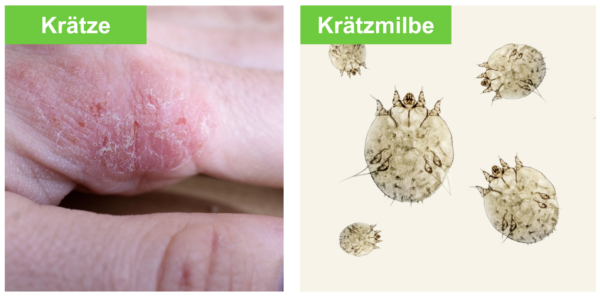 Milbenbisse erkennen und behandeln: Symptome und Mittel - ERASIO