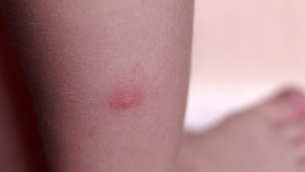 Milbenbisse erkennen und behandeln: Symptome und Mittel - ERASIO