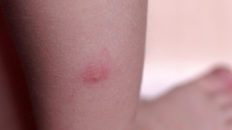 Milbenbisse erkennen und behandeln: Symptome und Mittel - ERASIO